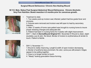 DermaWound for hard to heal woundcare | PDF