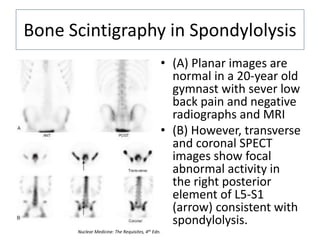 Nmt631 scintigraphy in common bone diseases | PPTX