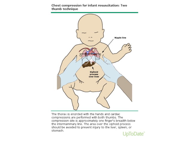 What is New in Neonatal Resuscitation .ppt