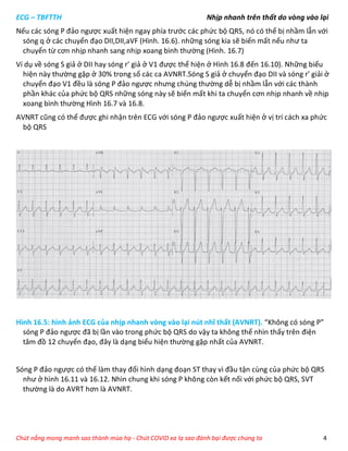 Nhịp nhanh trên thất do vòng vào lại slideshare | PDF