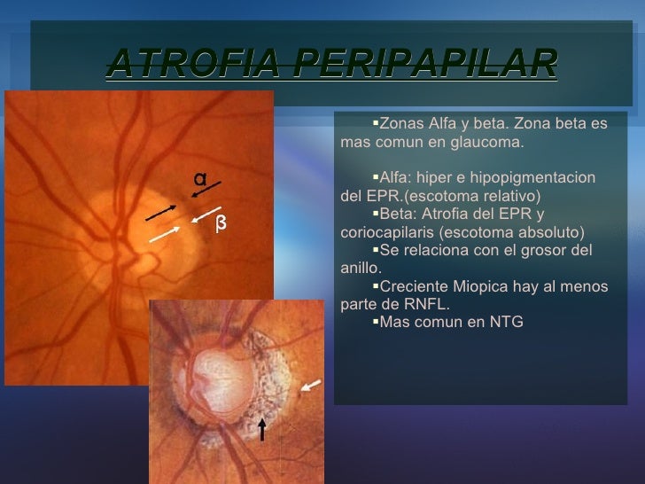 Nervio Optico en glaucoma