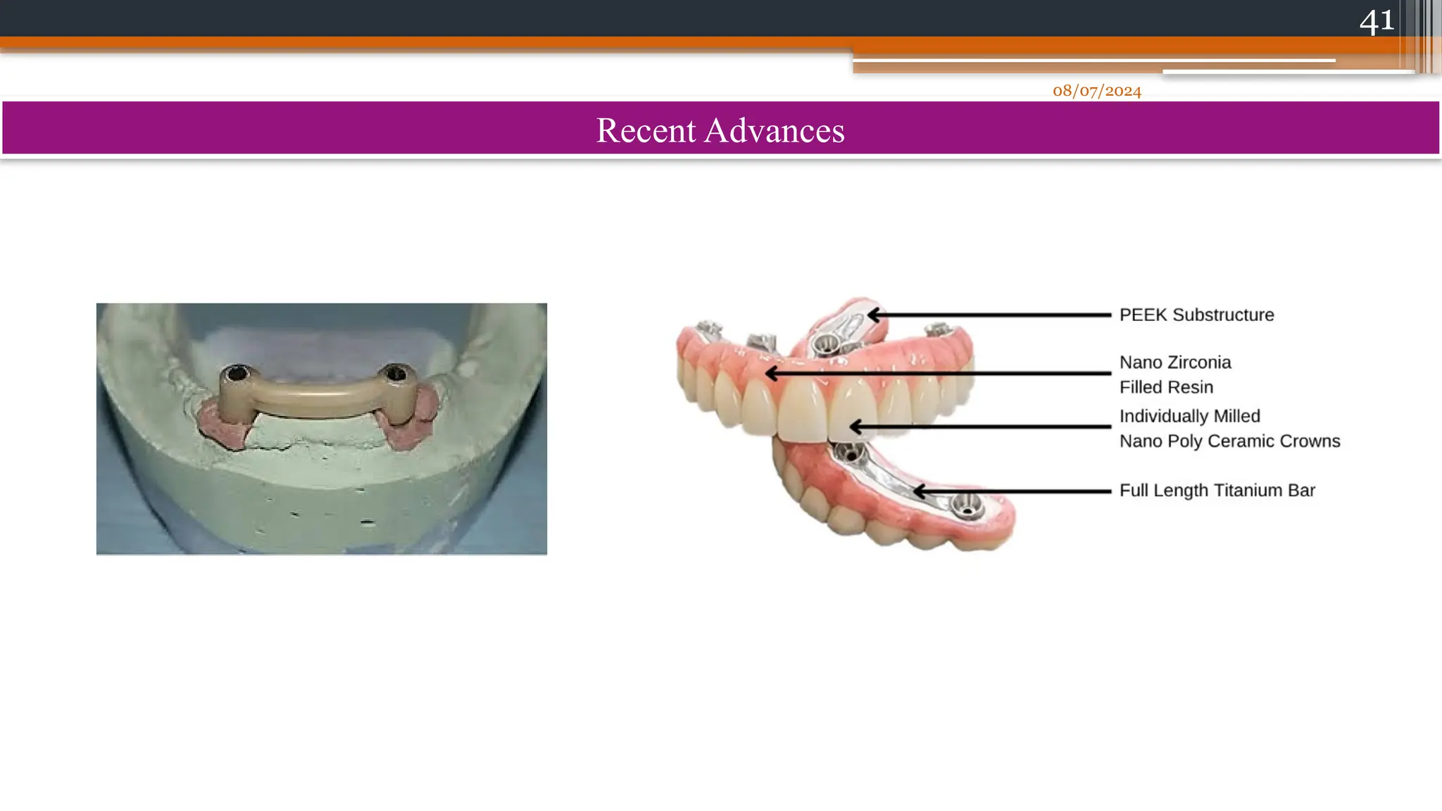 Hybrid Prosthesis...................pptx