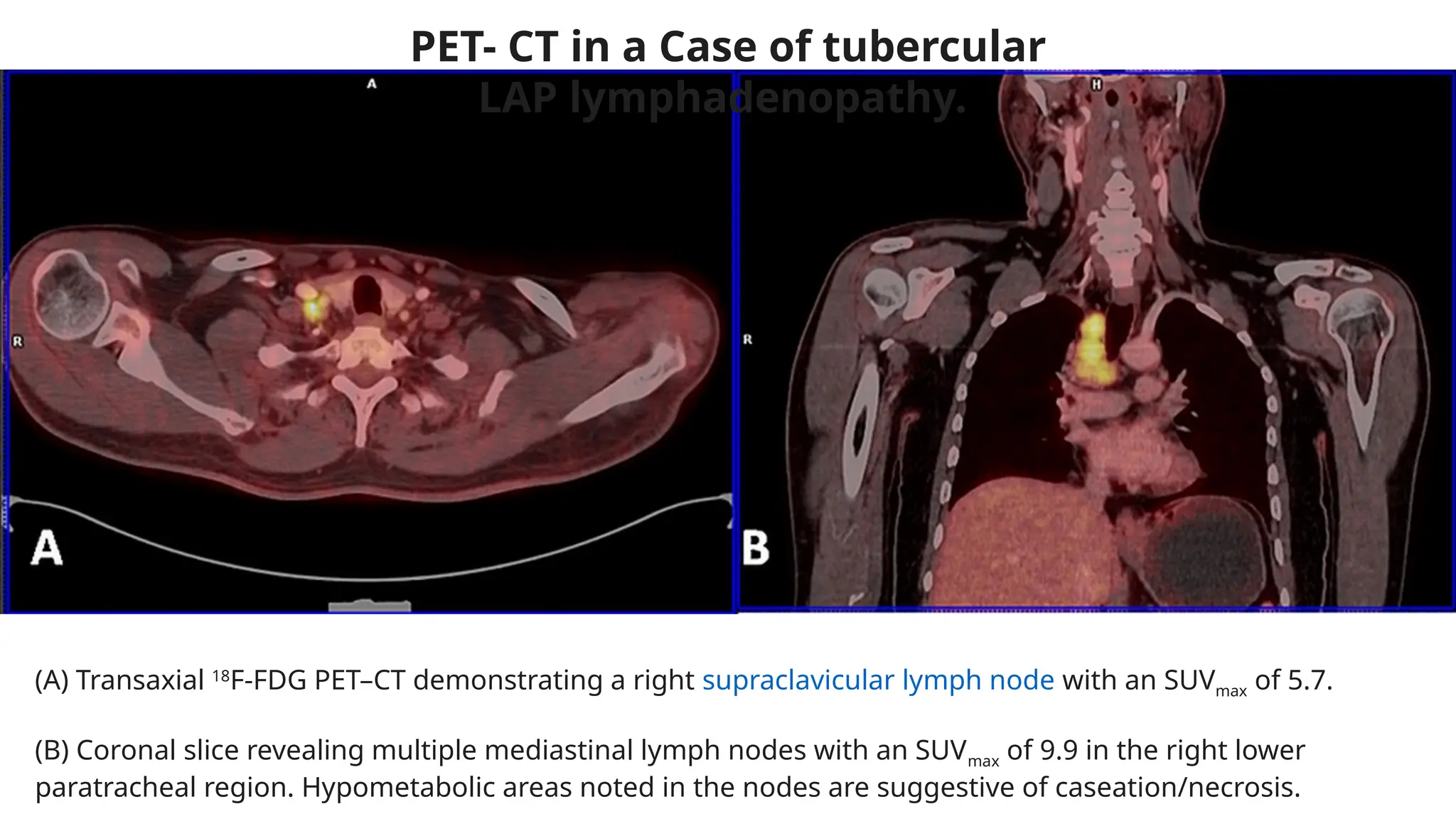 Nodal TB Diagnostics Modalities in children .pptx
