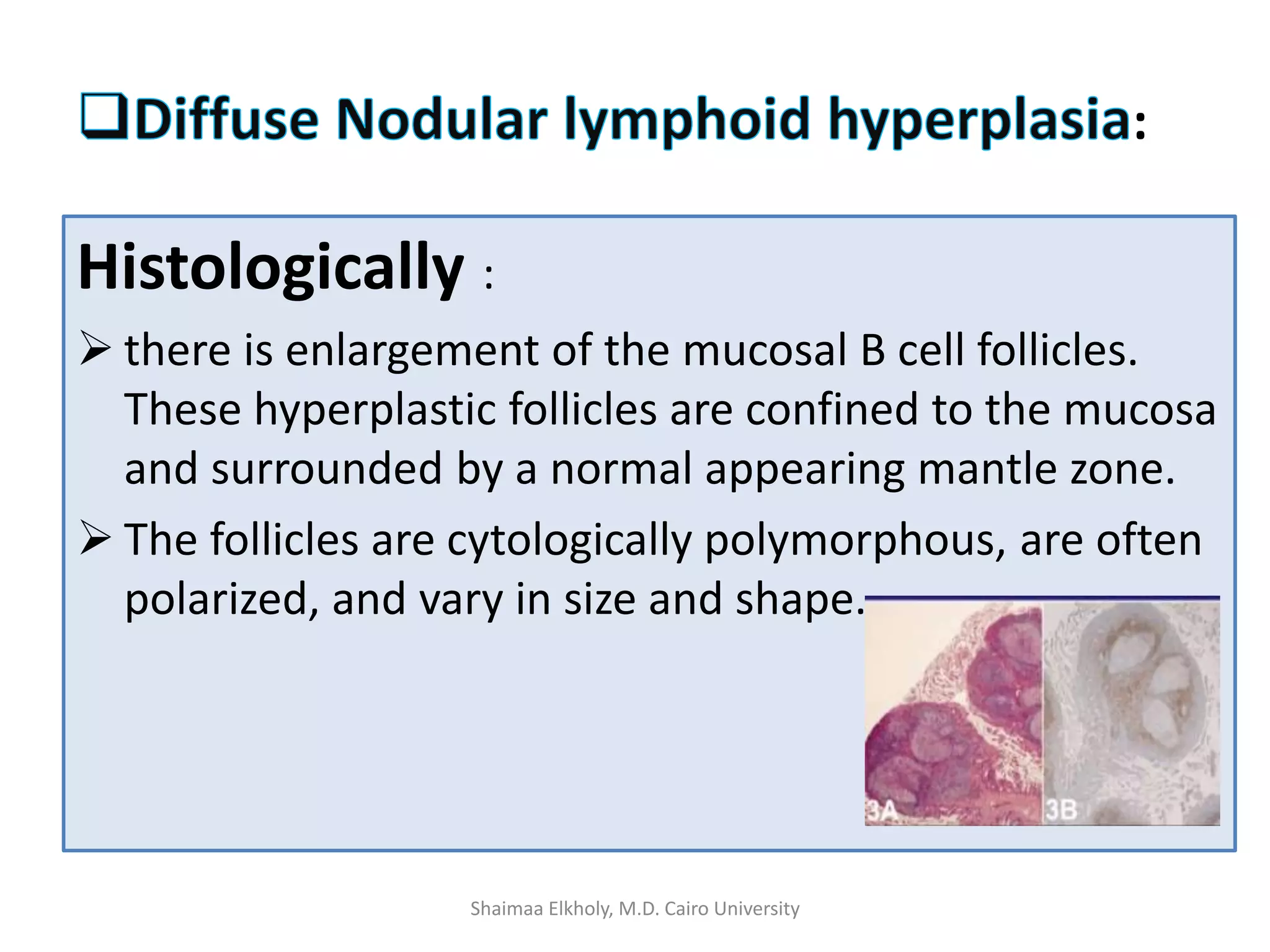 Diffuse Nodular Lymphoid Hyperplasia (DNLH) | PPTX