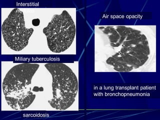 Nodular pattern | PDF | Lung and Respiratory Health | Diseases and ...