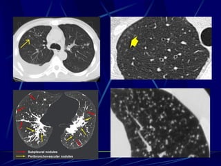 Nodular pattern | PDF | Lung and Respiratory Health | Diseases and ...