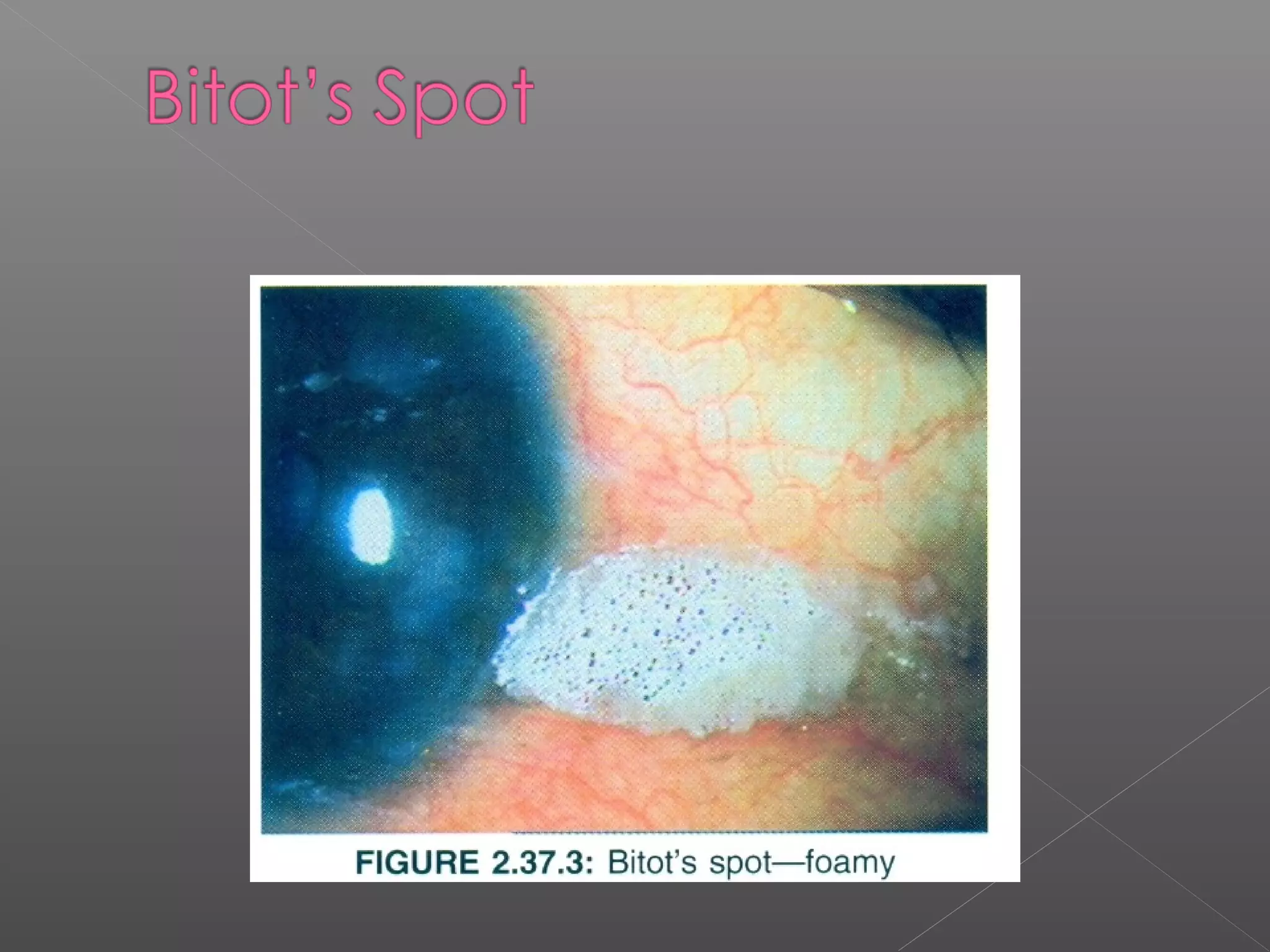 Nodule at the limbus | PPT