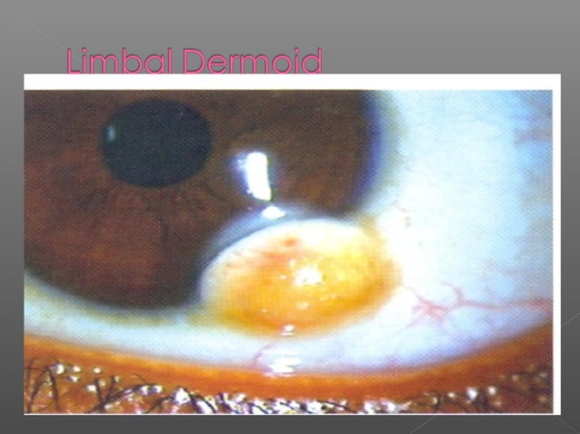 Nodule at the limbus | PPT | Eye and Vision Conditions | Diseases and ...