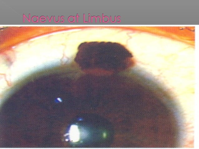 Nodule at the limbus | PPT | Eye and Vision Conditions | Diseases and ...