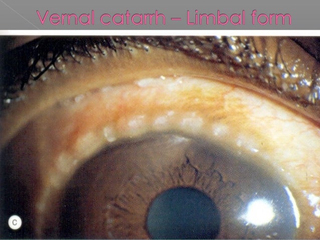 Nodule at the limbus