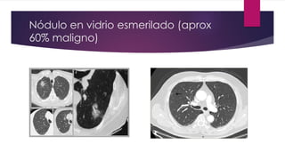 Nodulo pulmonar | PDF