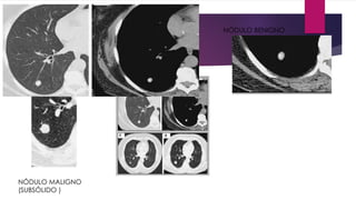 Nodulo pulmonar | PDF