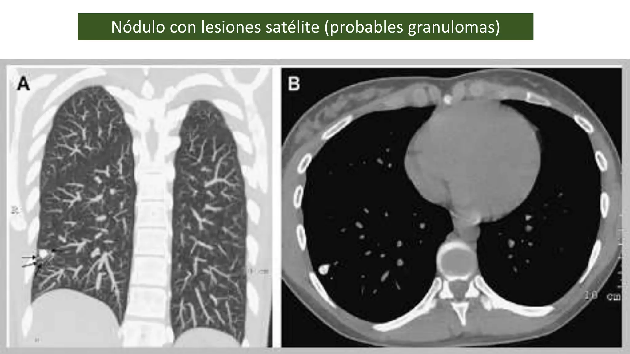 Estudio Del Nódulo Pulmonar Solitario | PPTX