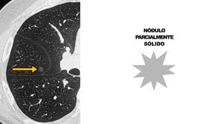 Nodulo pulmonar Nodulo pulmonar Nodulo pulmonar | PPTX