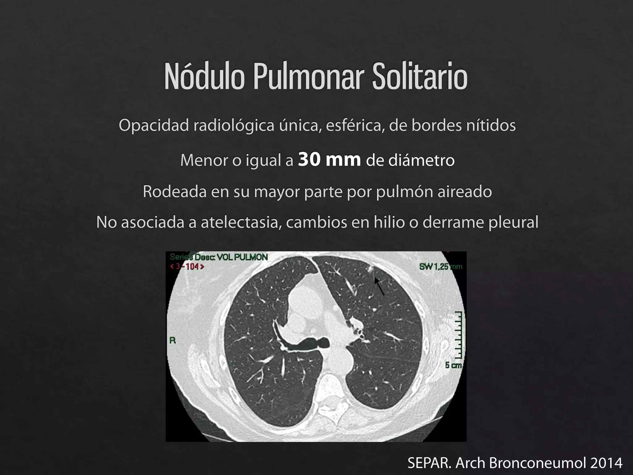 Nodulo pulmonar solitario | PDF