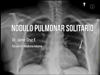 Nodulo pulmonar solitario | PDF