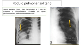 Nodulo pulmonar solitario | PPTX
