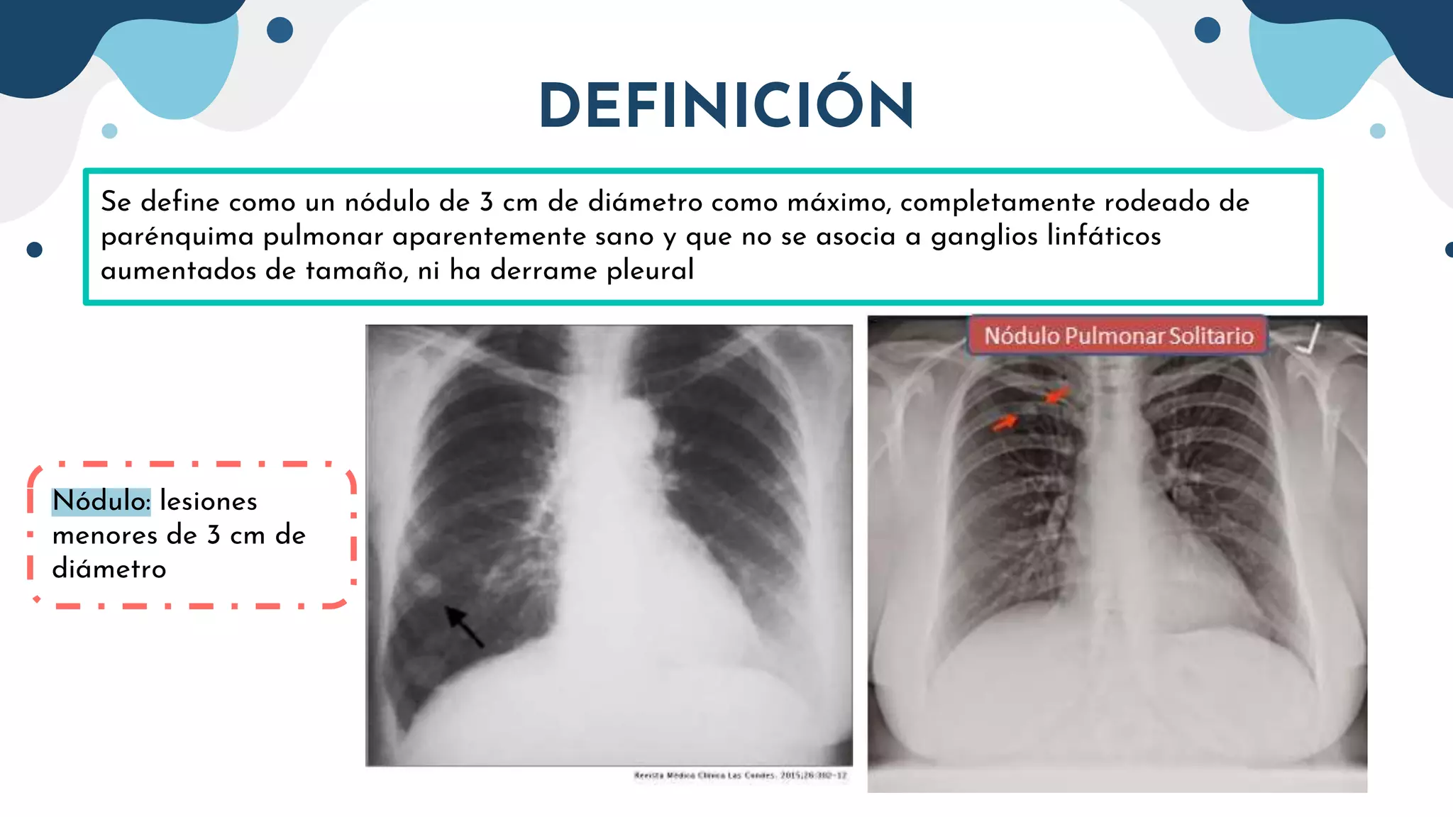 NODULO PULMONAR SOLITARIO .pptx