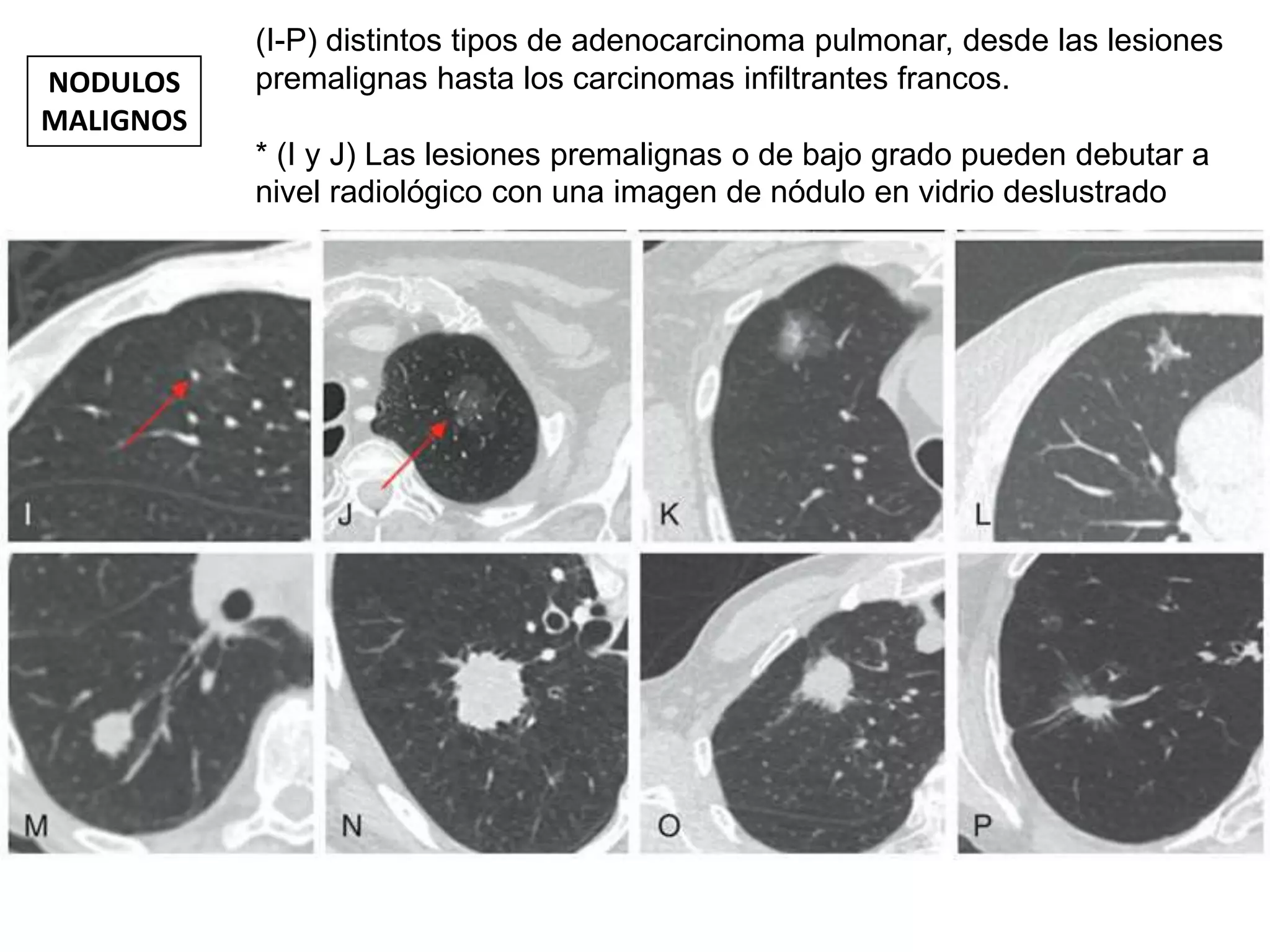 NODULOS PULMONARES.pptx