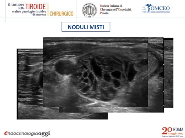 Nodulo tiroide chirurgia_20.5.2017