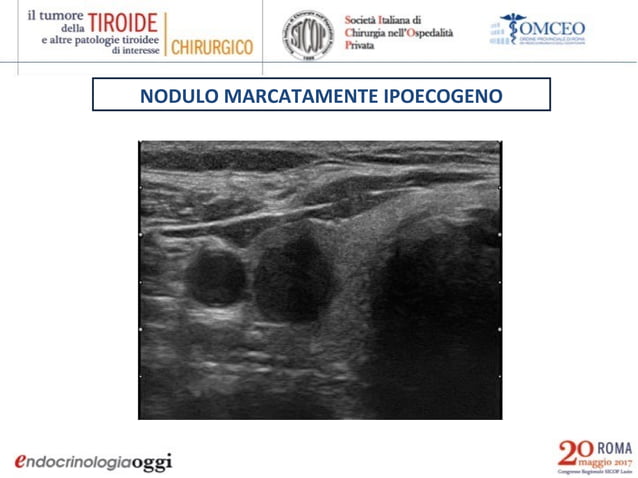 Nodulo tiroide chirurgia_20.5.2017