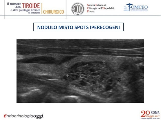 Nodulo tiroide chirurgia_20.5.2017
