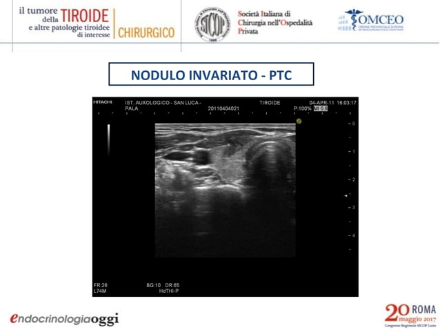 Nodulo tiroide chirurgia_20.5.2017