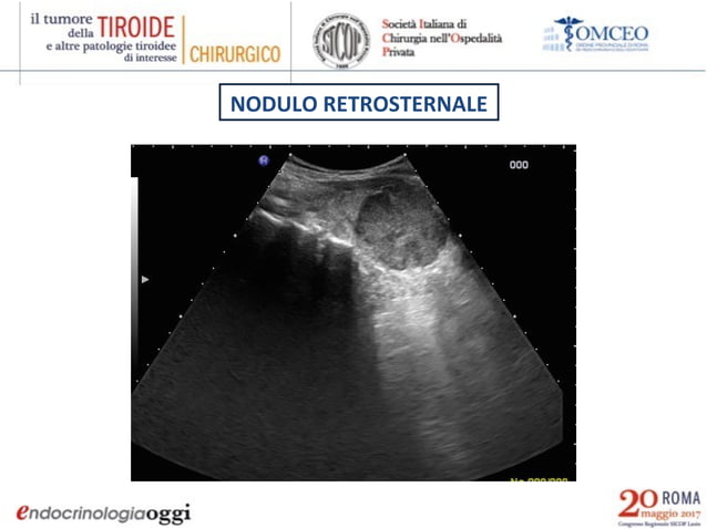 Nodulo tiroide chirurgia_20.5.2017