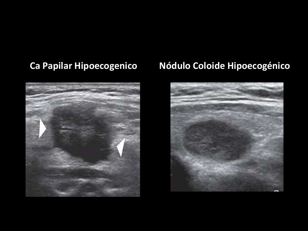 Nódulo Isoecogênico Na Tireoide Ti-rads 3 - RETOEDU