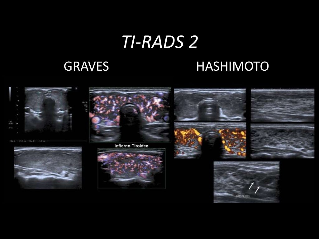 Nódulo tiroideo ti rads eco baaf
