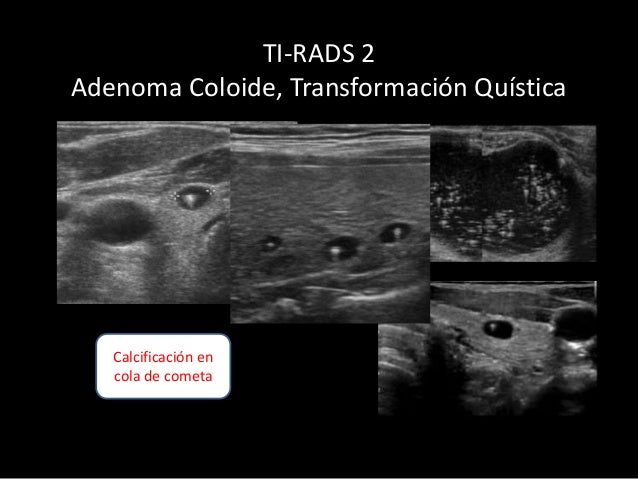 Nodulo tiroideo ti rads ecobaaf