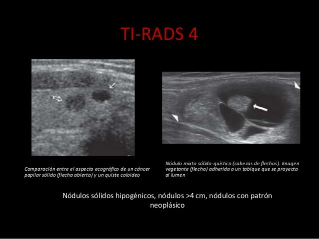 Nodulo tiroideo ti rads ecobaaf