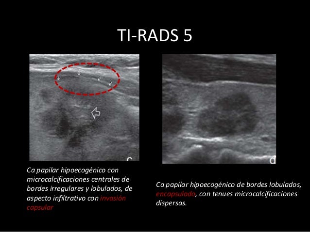 Nodulo tiroideo ti rads ecobaaf
