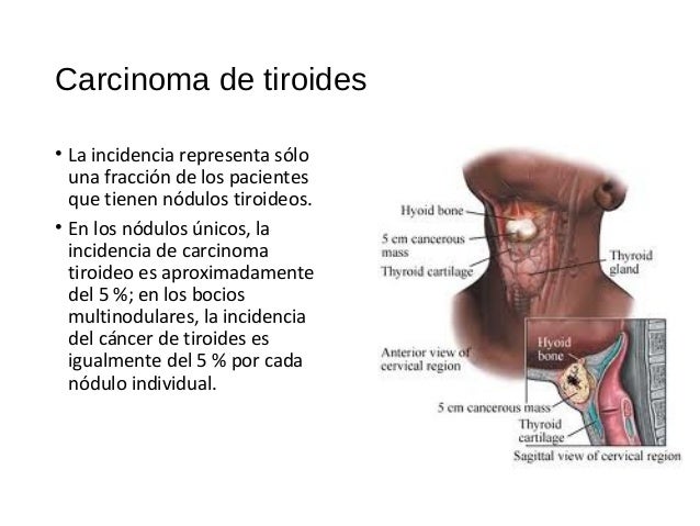 Nodulo y Neoplasias malignas de tiroides