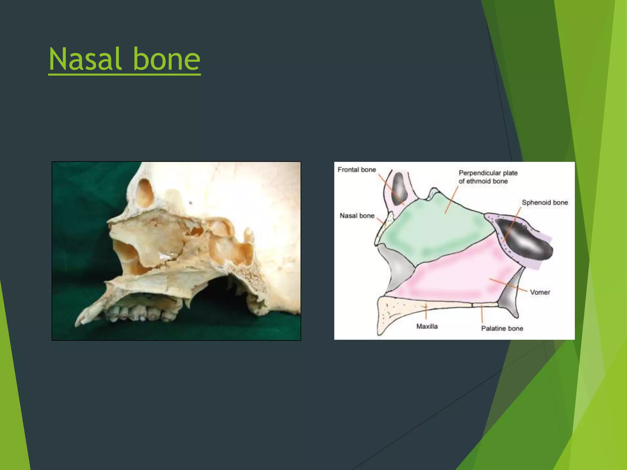Naso-orbito-ethmoidal fracture | PPTX