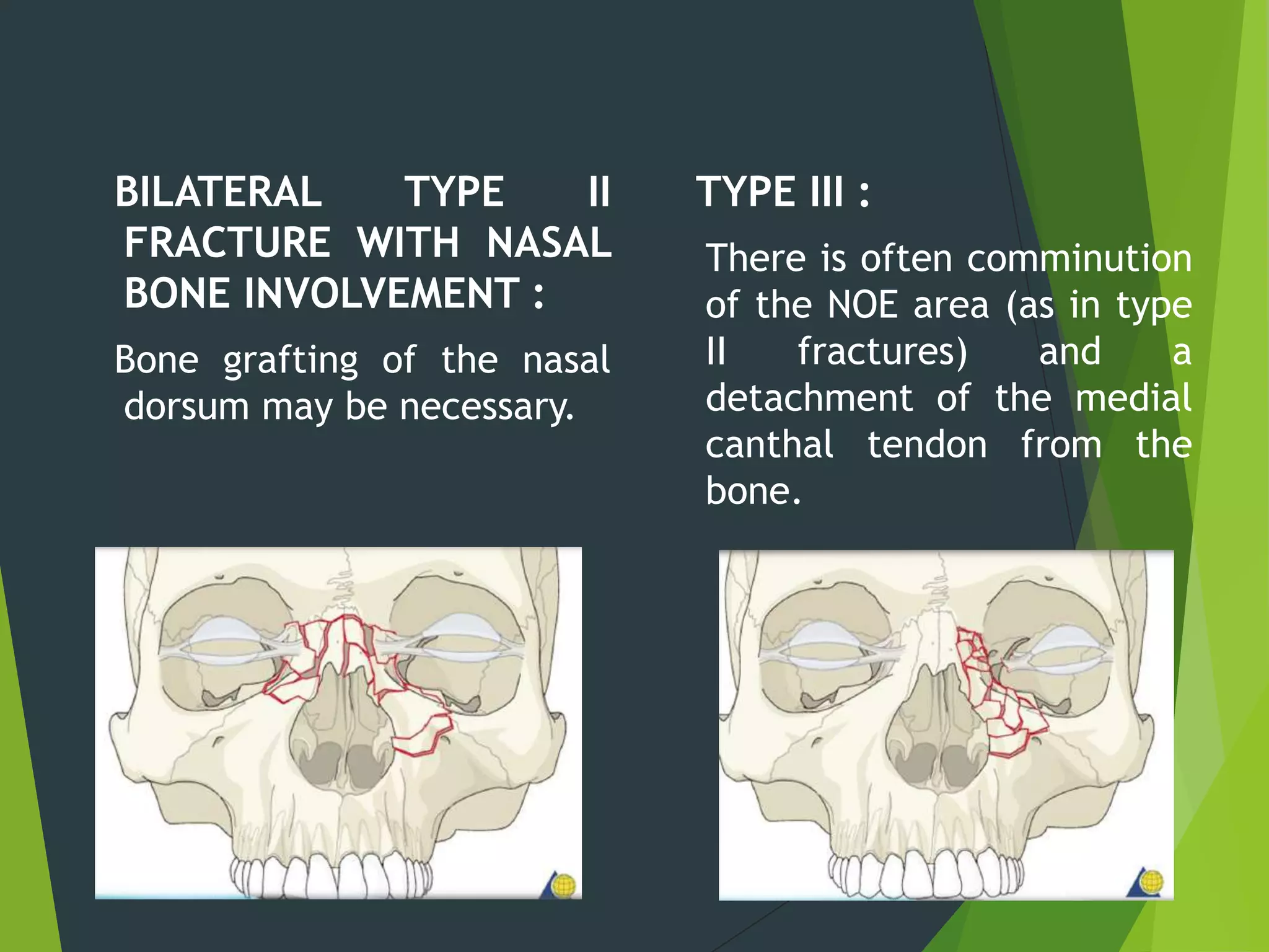 Naso-orbito-ethmoidal fracture | PPTX