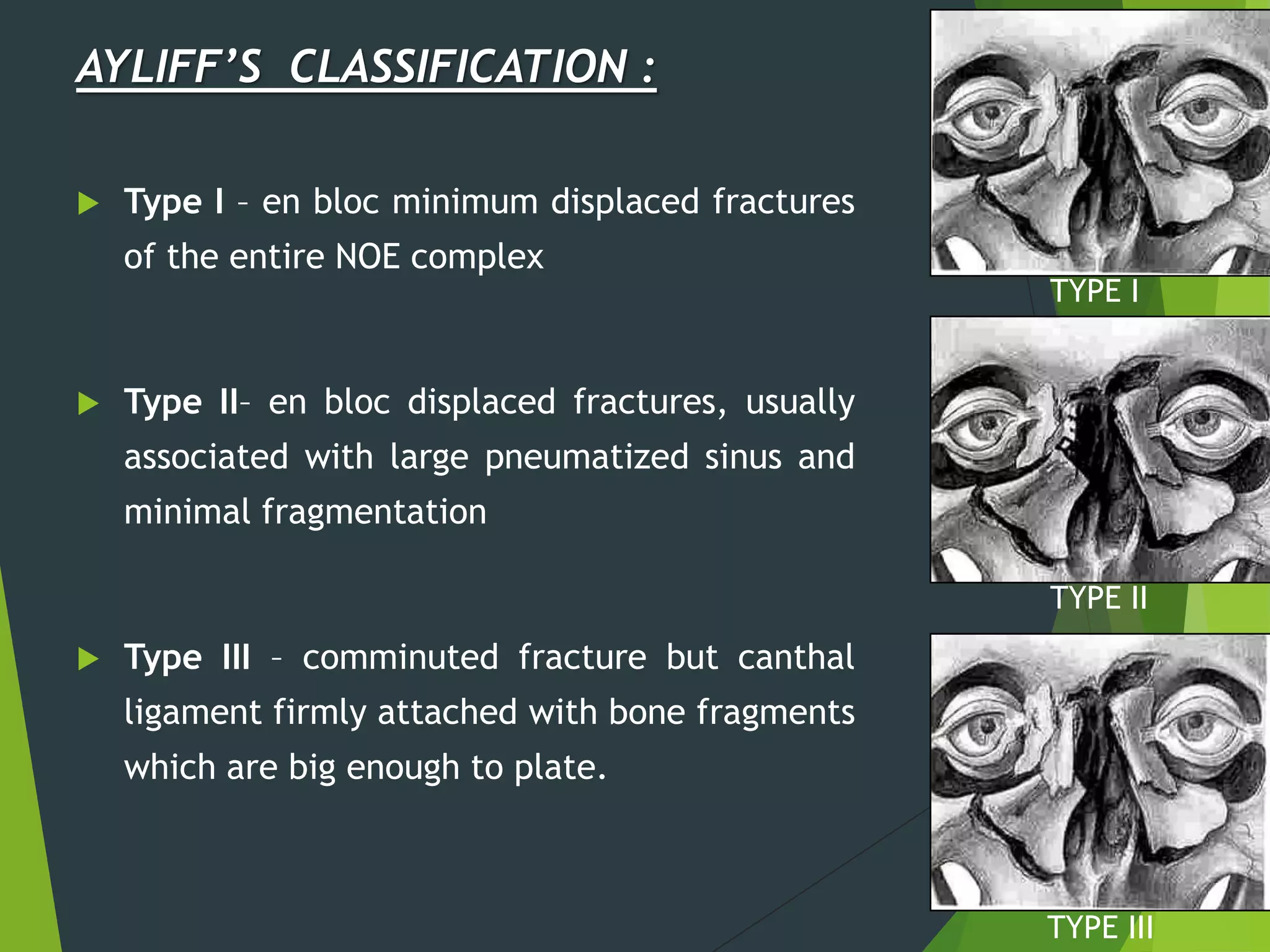 Naso-orbito-ethmoidal fracture | PPTX