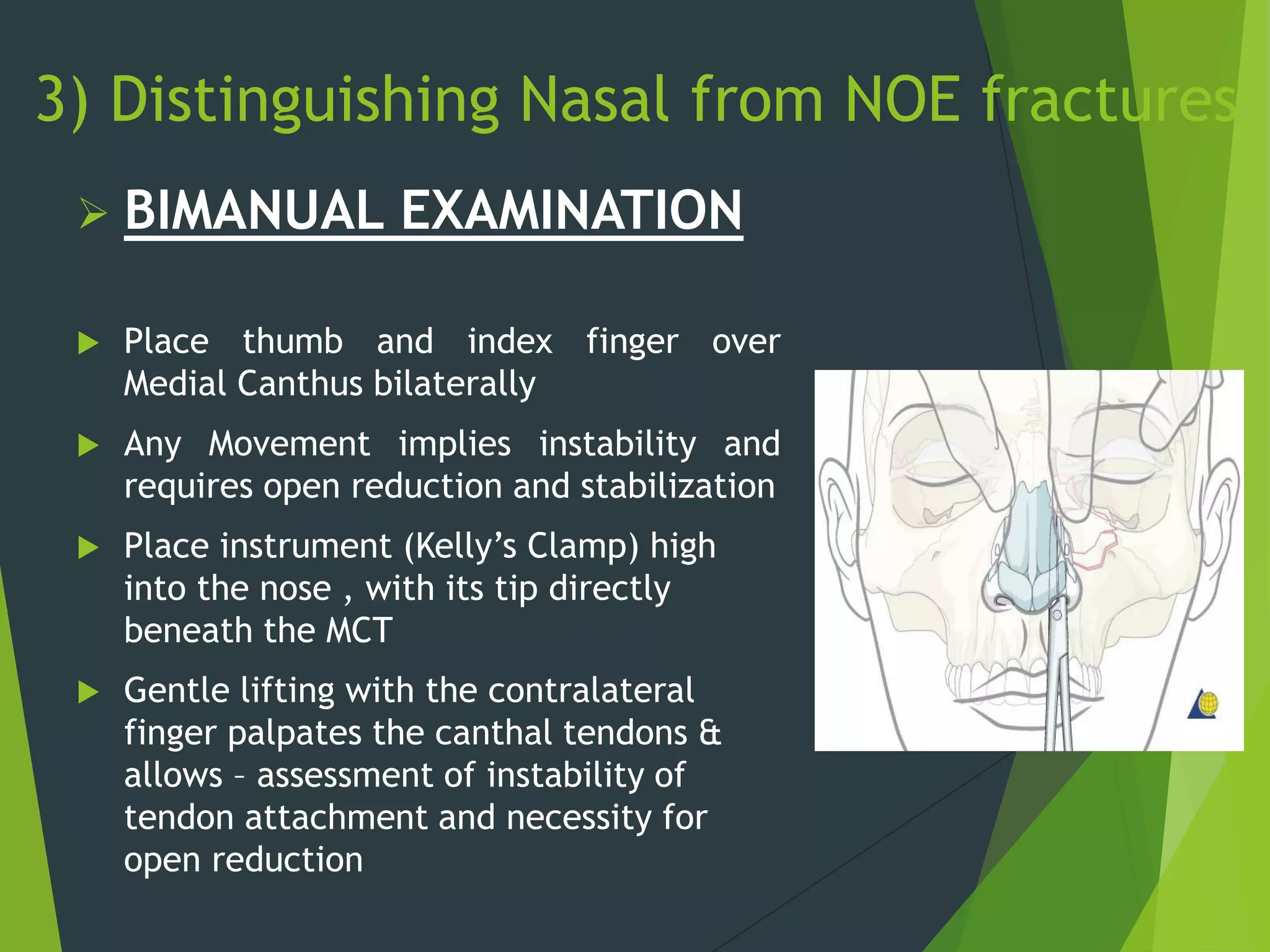 Naso-orbito-ethmoidal fracture | PPTX