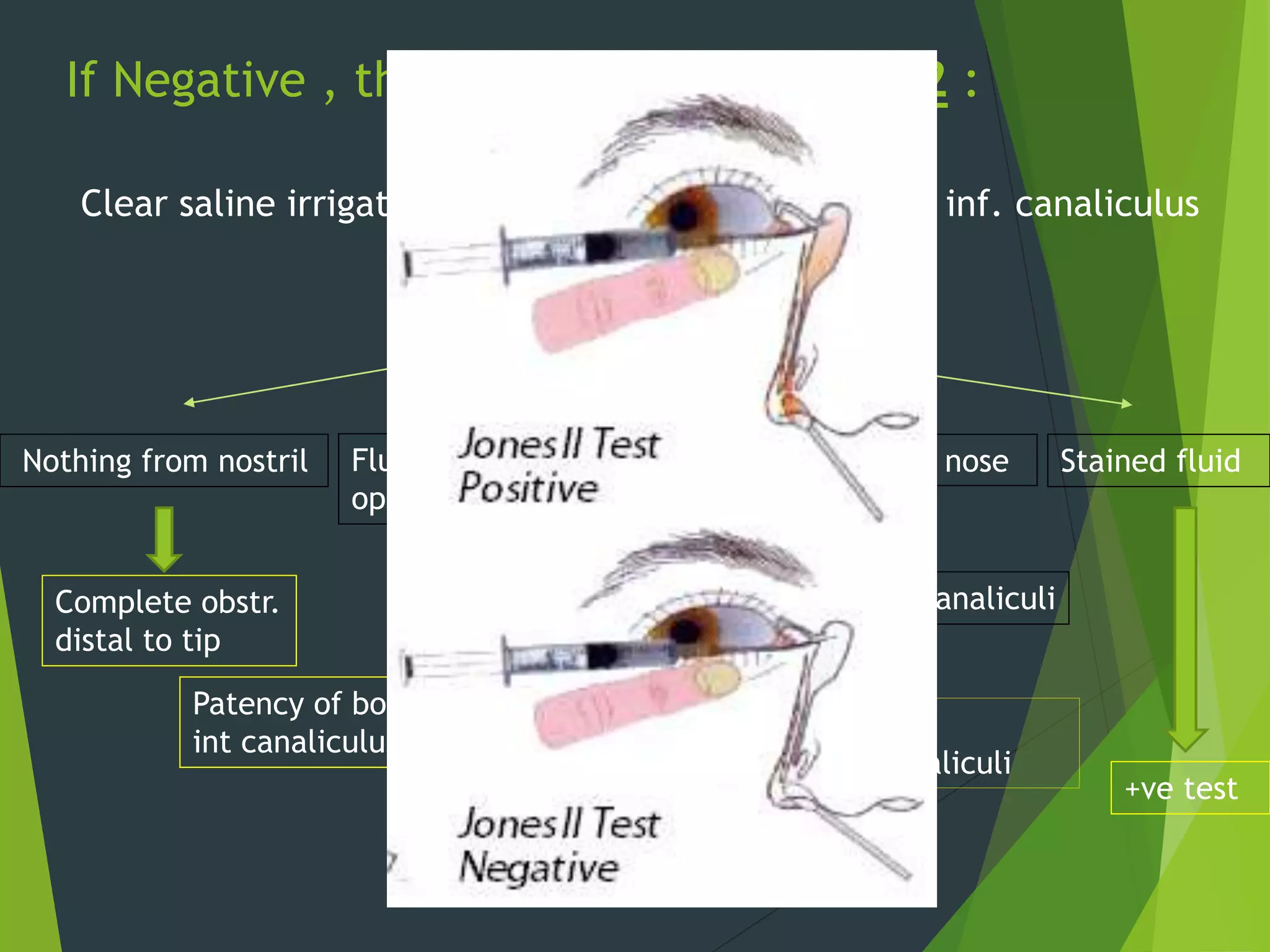 Naso-orbito-ethmoidal fracture | PPTX
