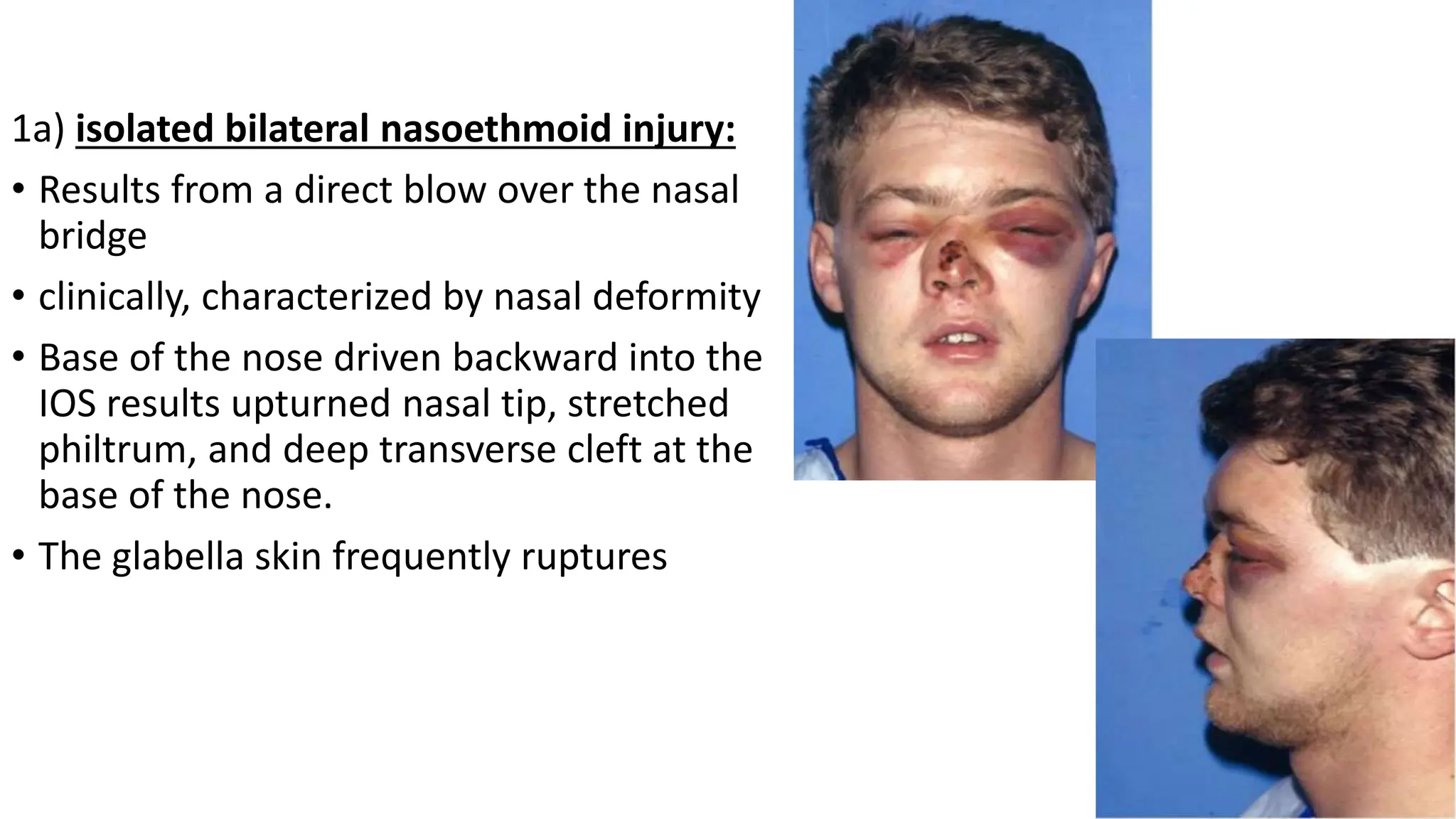 NOE fracture.pptx