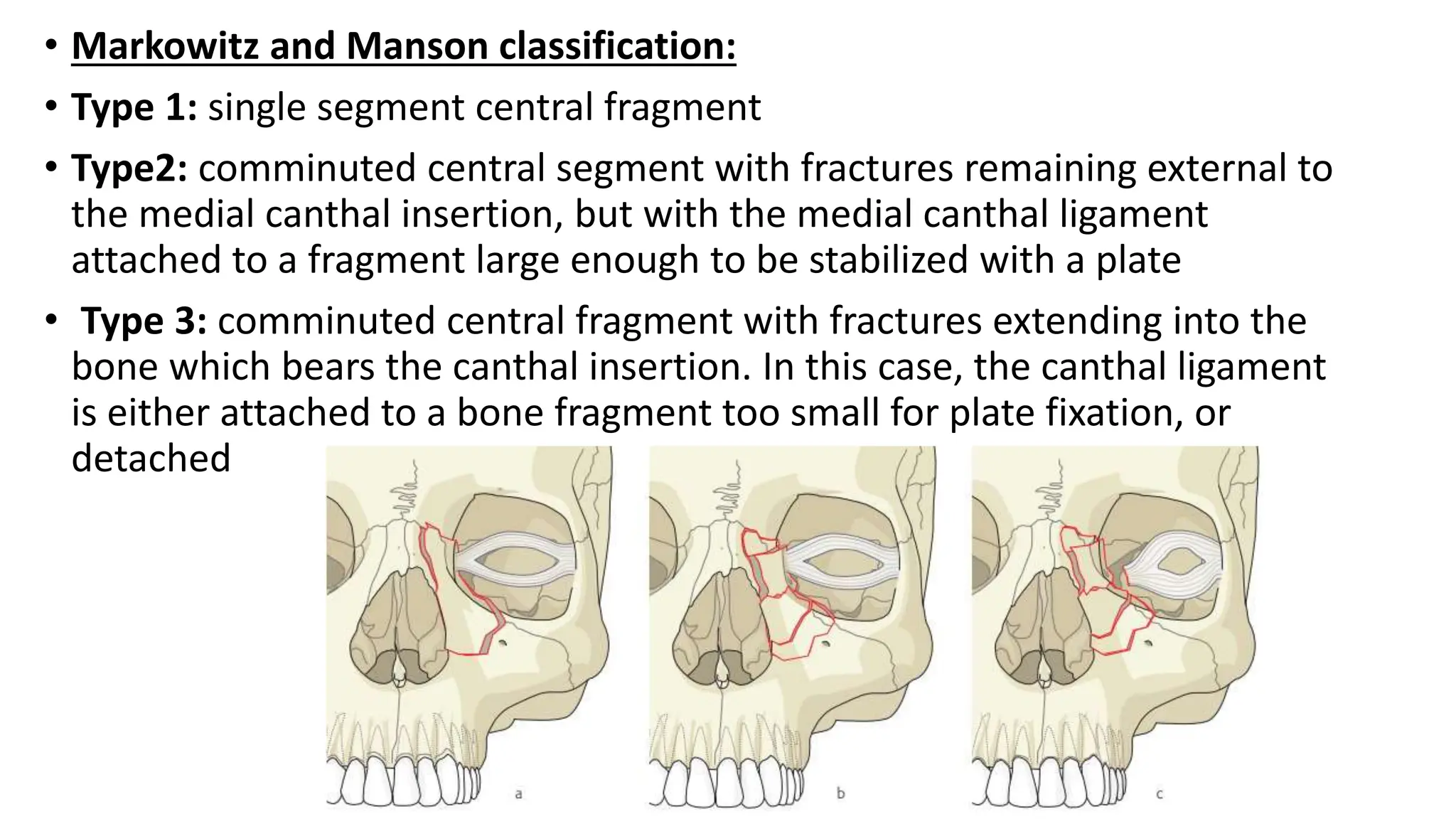 NOE fracture.pptx