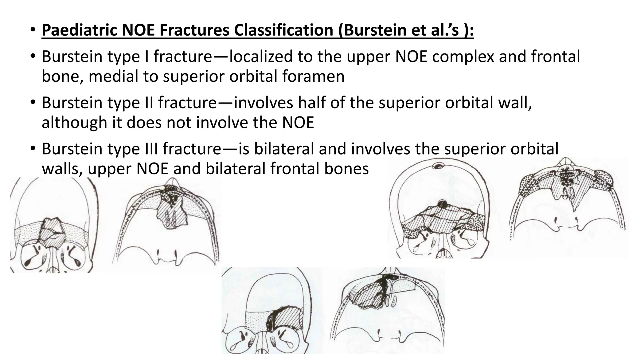 NOE fracture.pptx