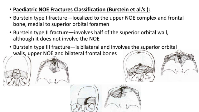 NOE fracture.pptx | Death, Injury, or Military Conflict | Sensitive Topics