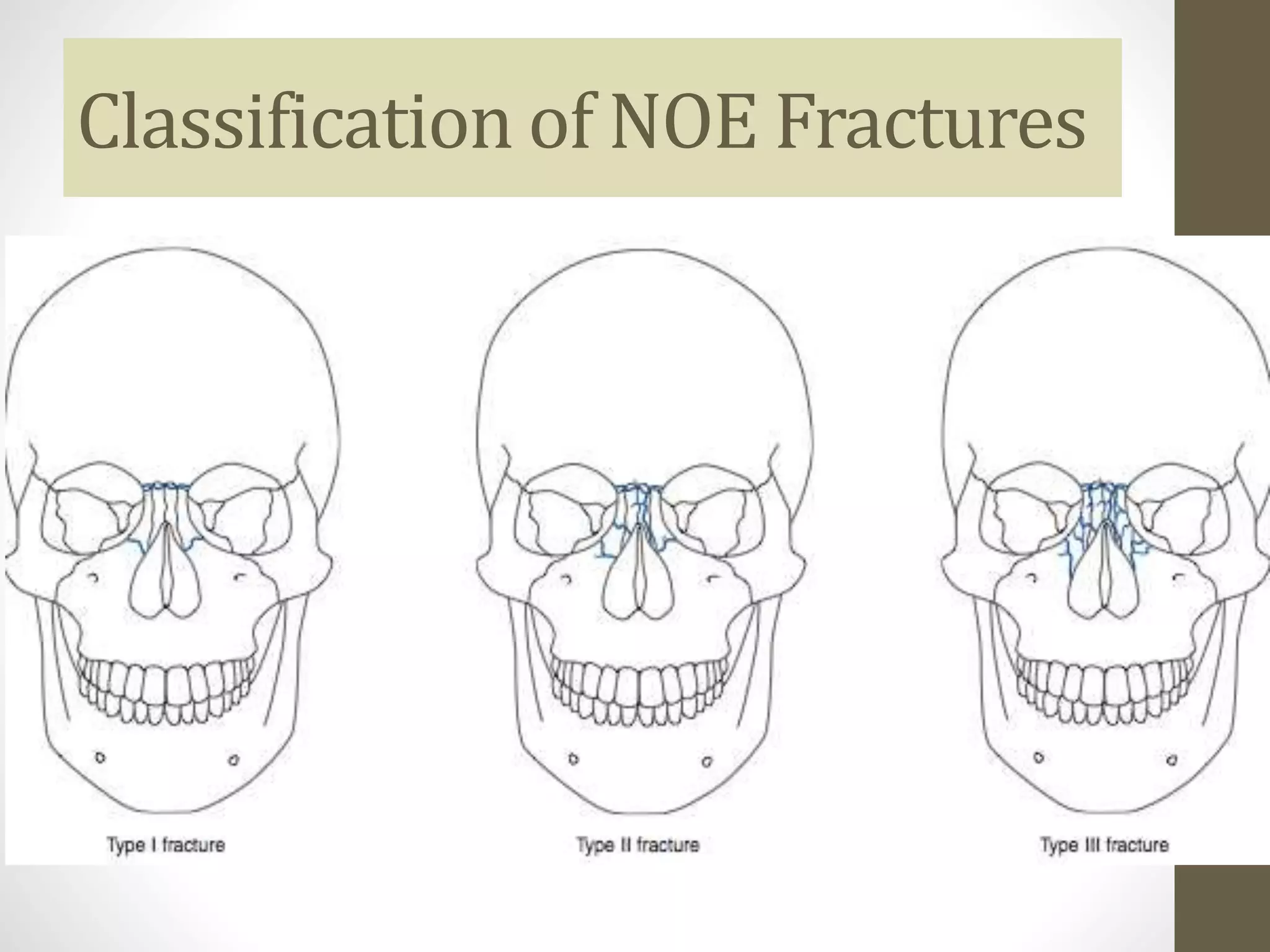 NOE fractures | PPTX