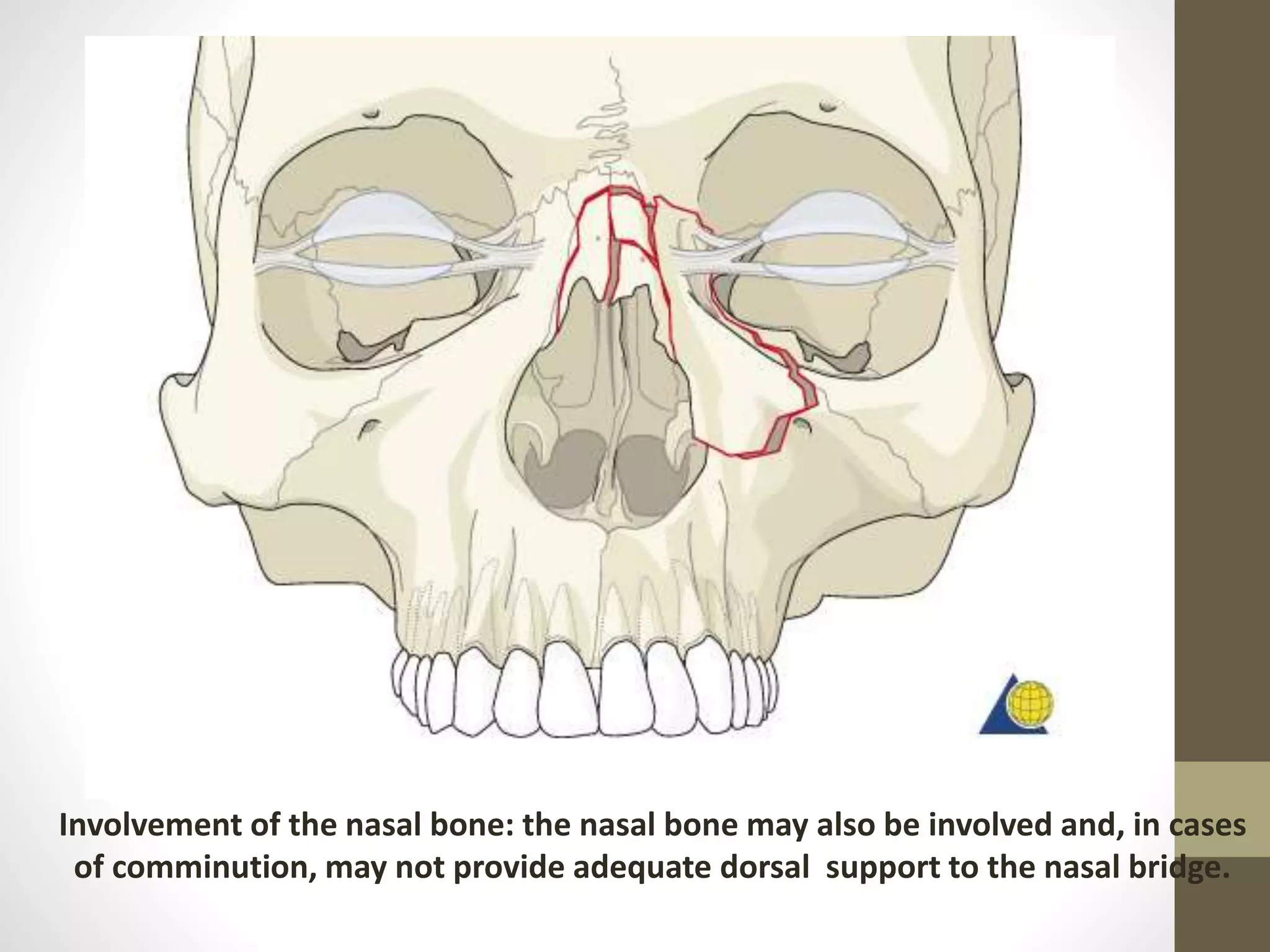 NOE fractures | PPTX