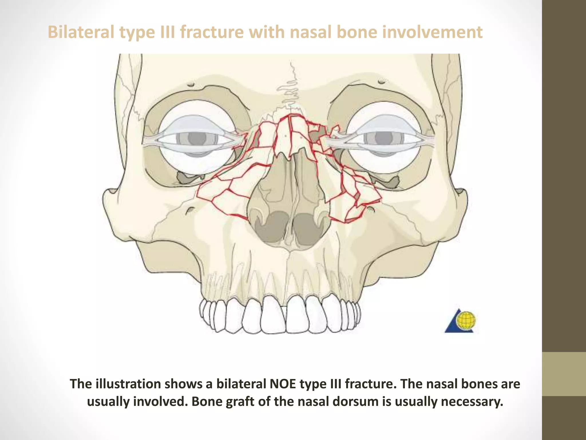 NOE fractures | PPTX