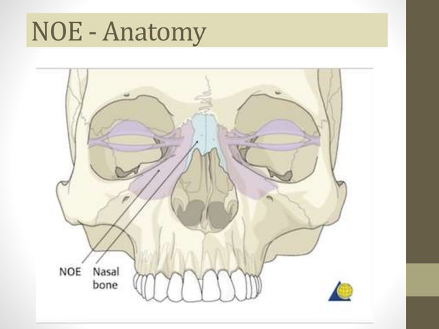 NOE fractures | PPTX