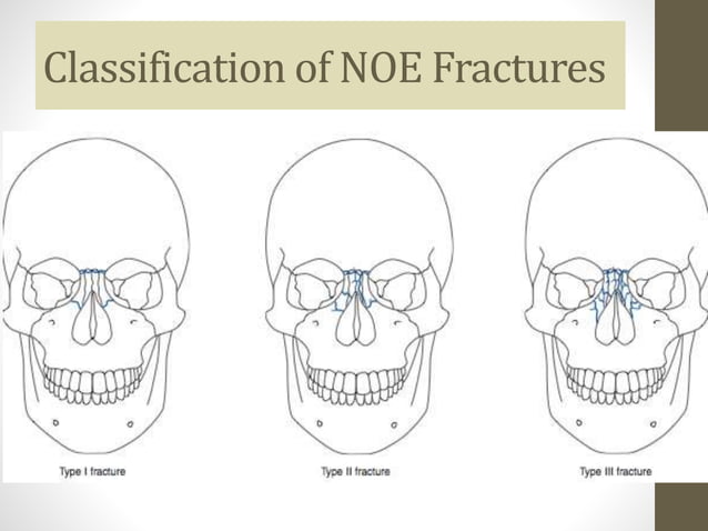 NOE fractures | PPTX