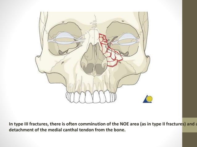 NOE fractures | PPTX