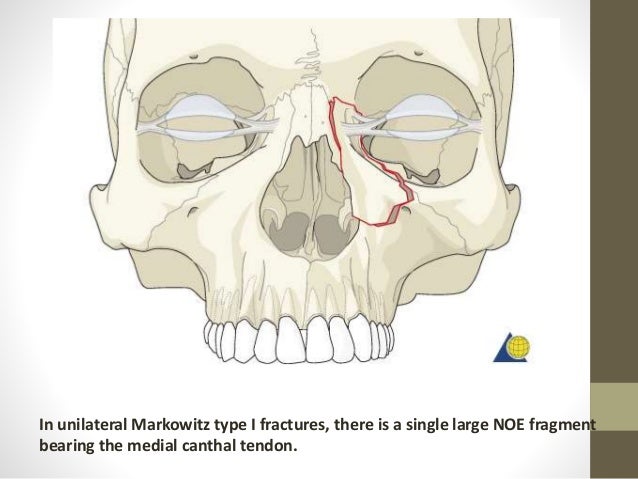NOE fractures